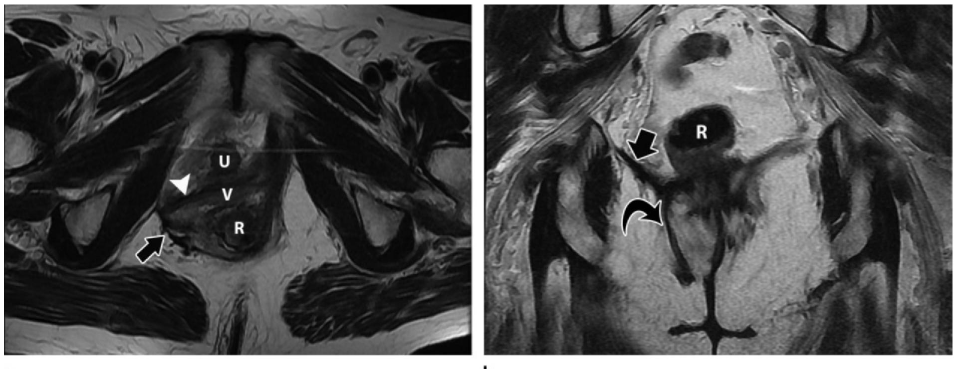 Pelvic muscle defects in a 54-year-old woman with fecal