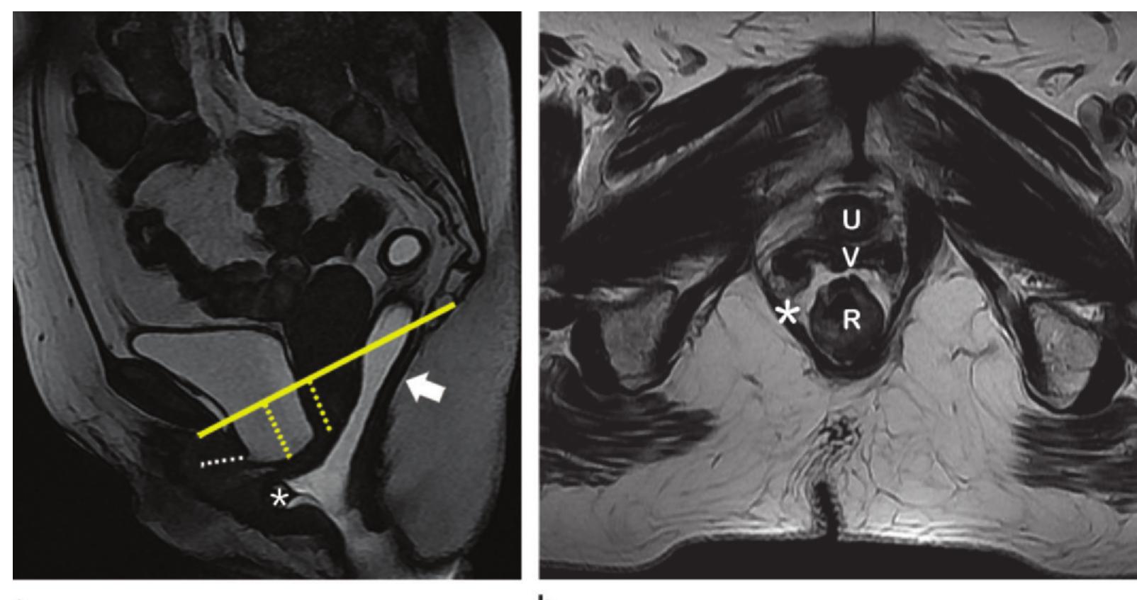 Pelvic organ prolapse in a 47-year-old woman with stress