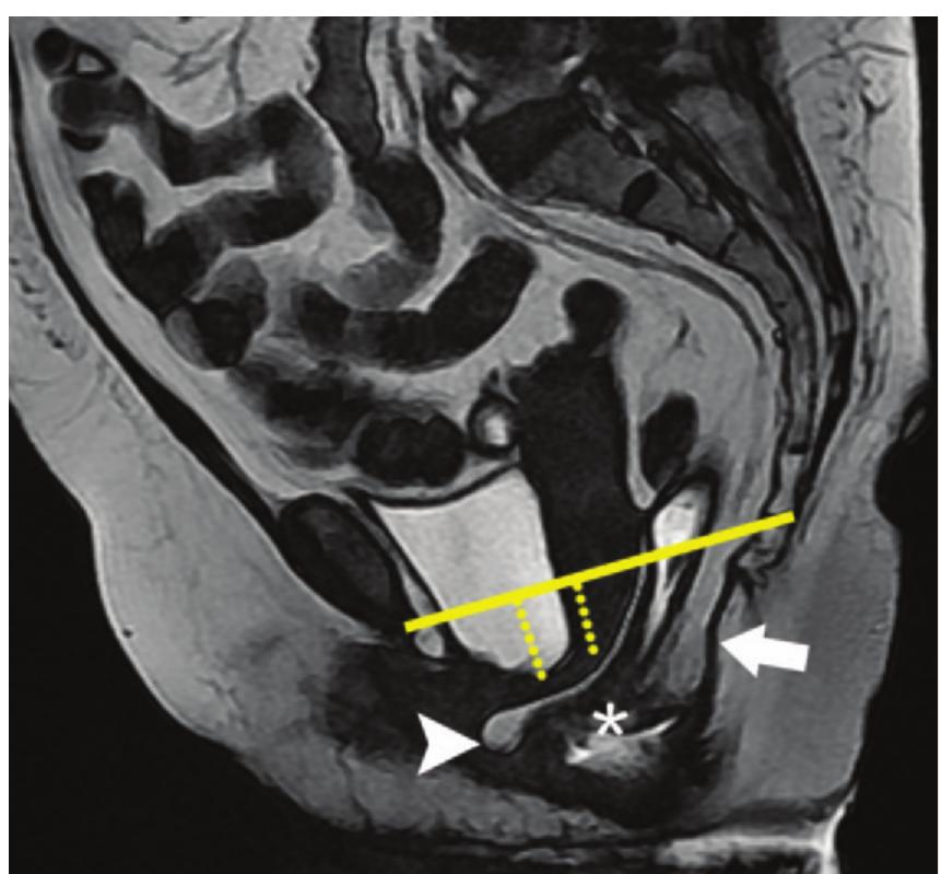Peritoneocele in a 60-year-old woman who had a history of