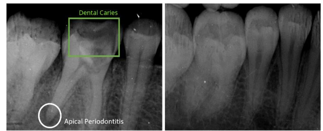(a). dental caries affected mandibular left first molar