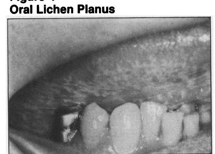 White lines and papules are present in a reticular pattern