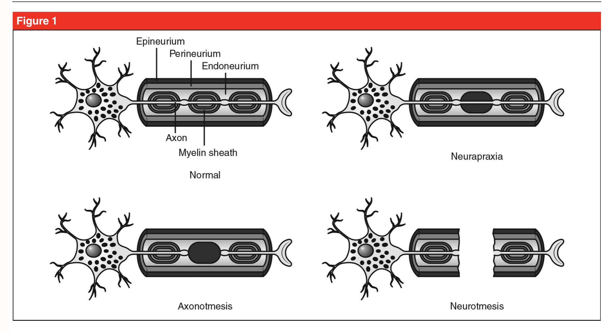 Illustration of a normal nerve fiber and the three grades of