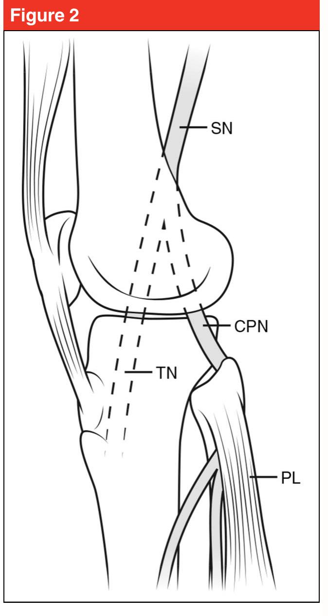 Illustration of the knee joint demonstrating the course of