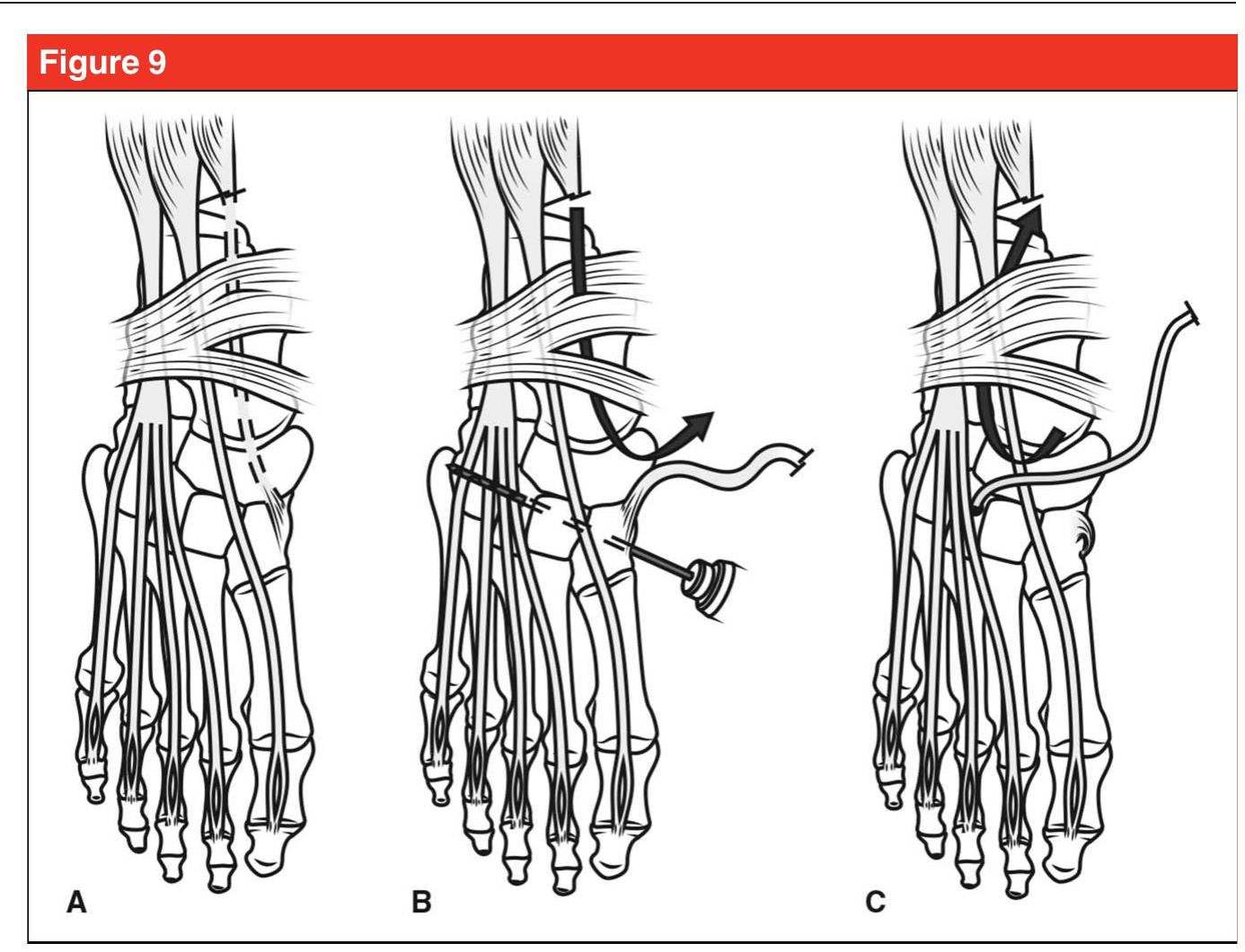 Illustrations demonstrating the anterior tibialis tendon