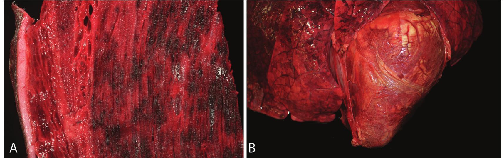 Gross lesions of clostridium chauvoei infection in a 2-y-old