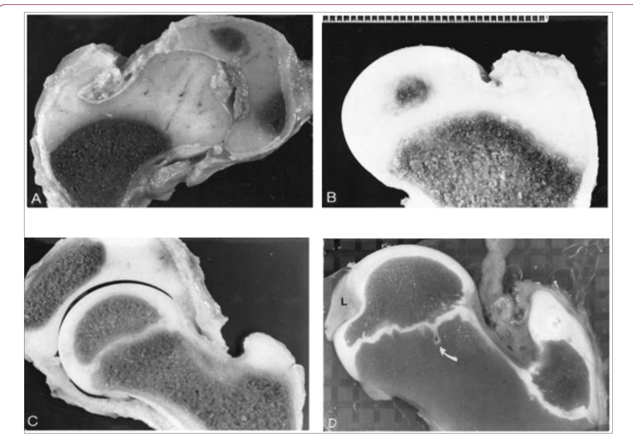 Slab sections showing proximal femoral development. (a) at 2