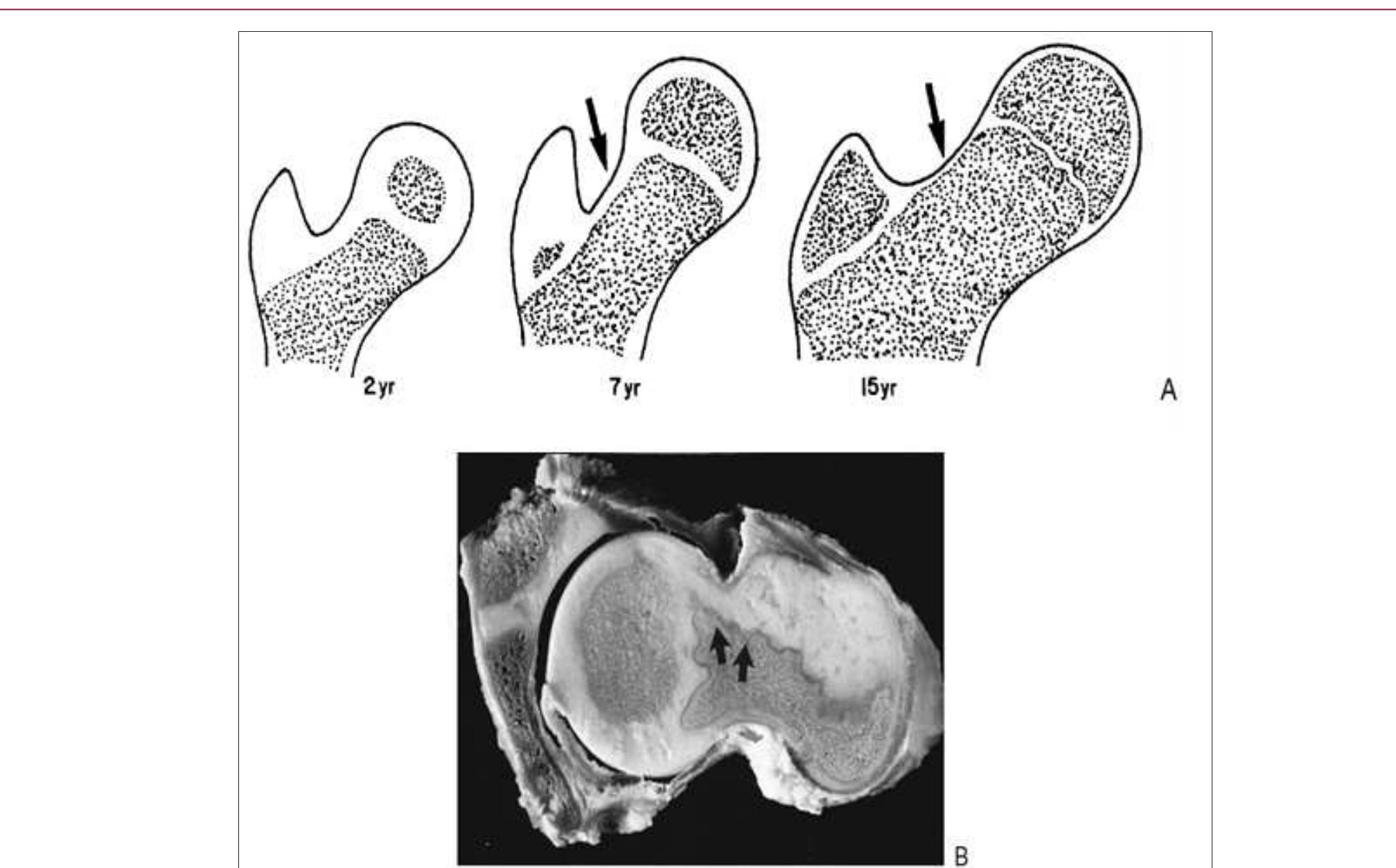 (a) progressive proximal femoral development. a segment of