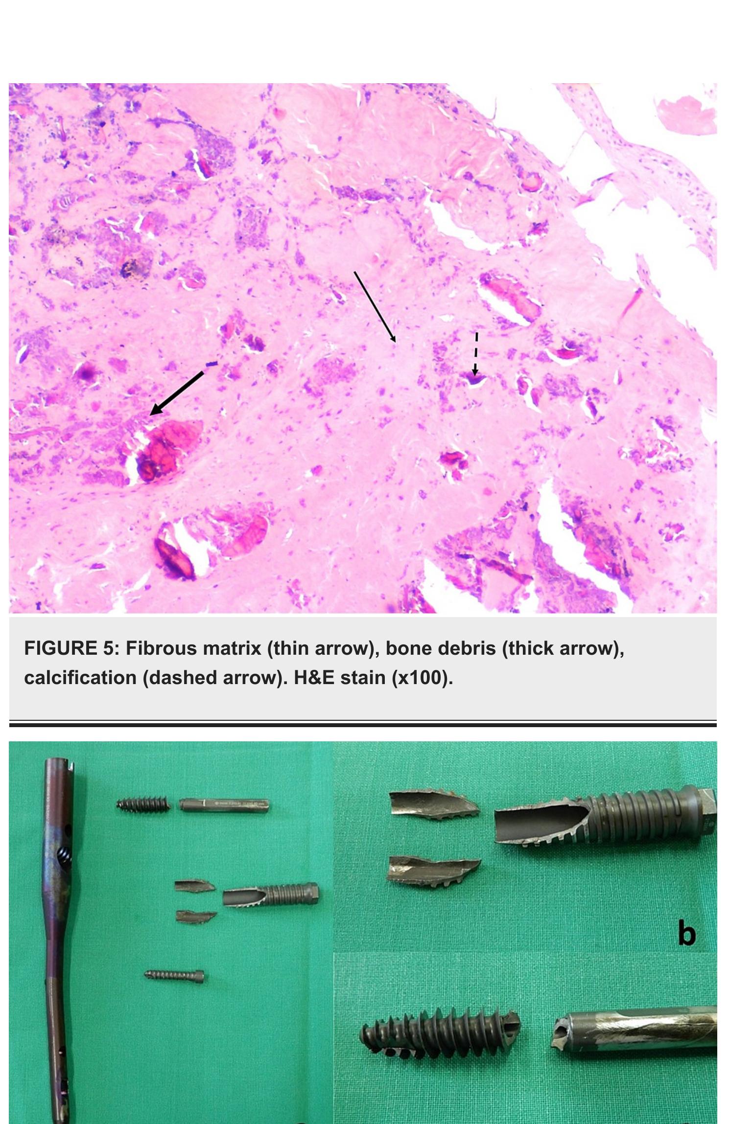 Figure 5 - Proximal Femoral Nail Mechanical Failure: A Case