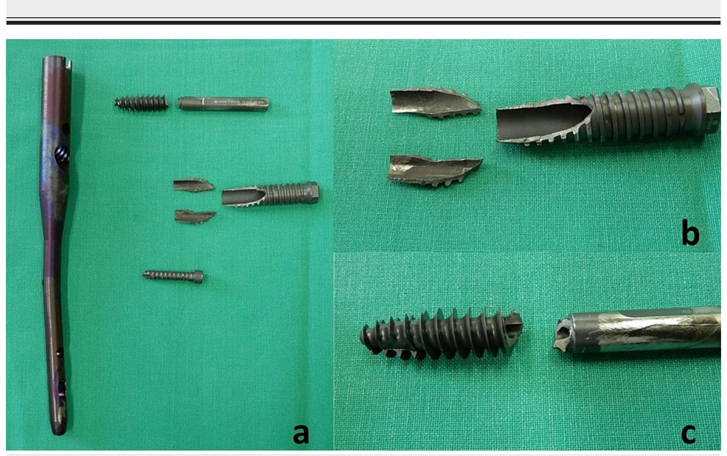 Figure 7 - from Proximal Femoral Nail Mechanical Failure: A