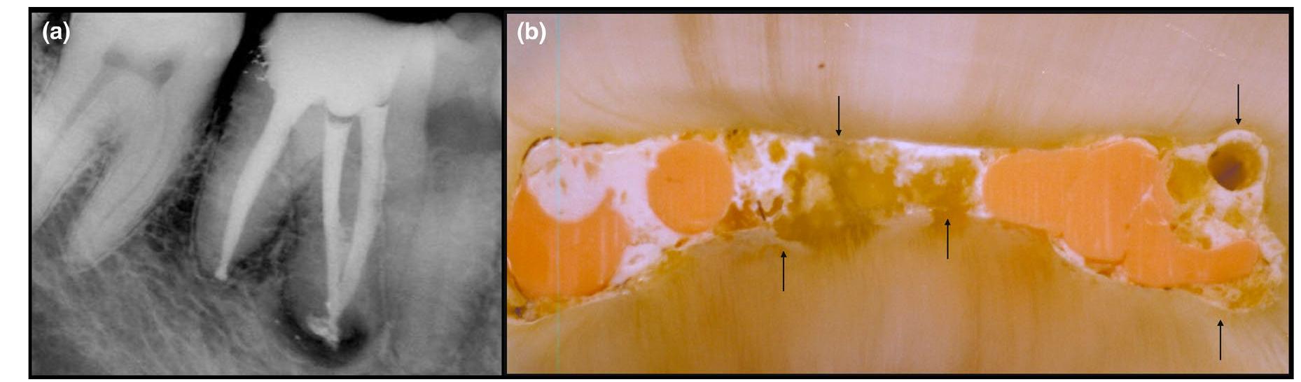 (a) failed mandibular first molar tooth filled with warm