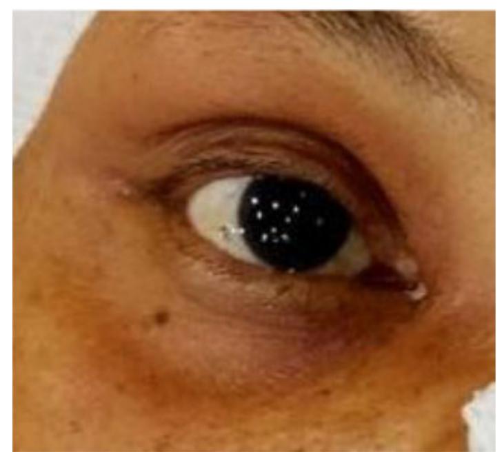 Gambar 1. edema pada kelopak mata kanan bawah.