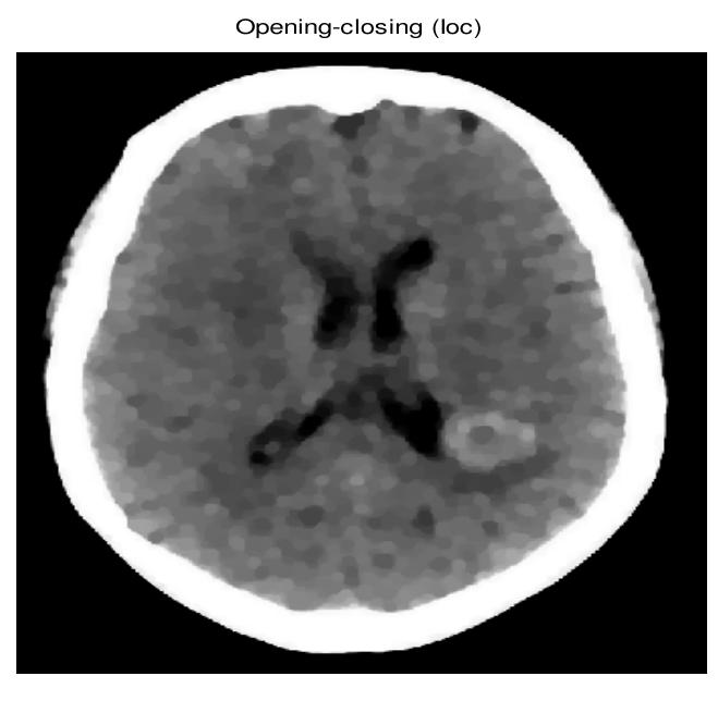 Figure 15 - Detecting Brain Tumour from Mri Image Using