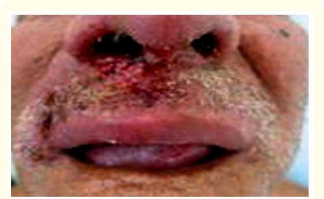 Muco-cutaneous leishmaniasis. larynx, and the nose and lip