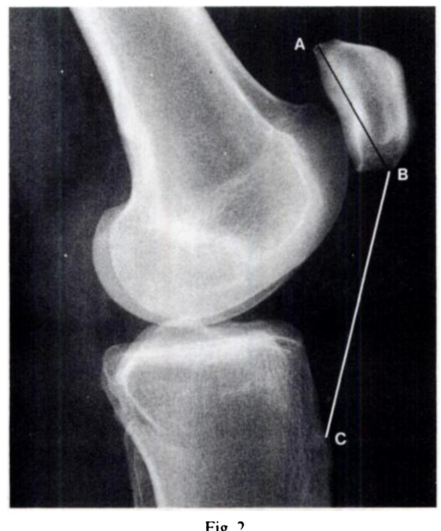 The patellar tendon: patella ratio (insall and salvati 1971)