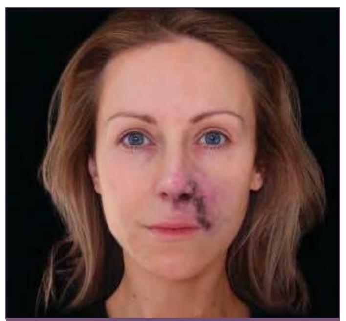 Assessing the stages of a vascular occlusion figure 2c.