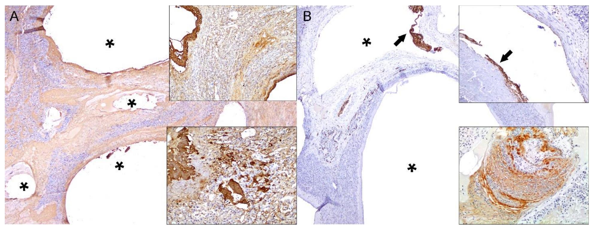 Immunohistochemical features of cystic liver lesions in