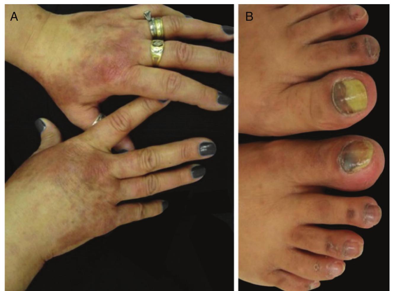 Pateo syndrome (periarticular thenar erythema and