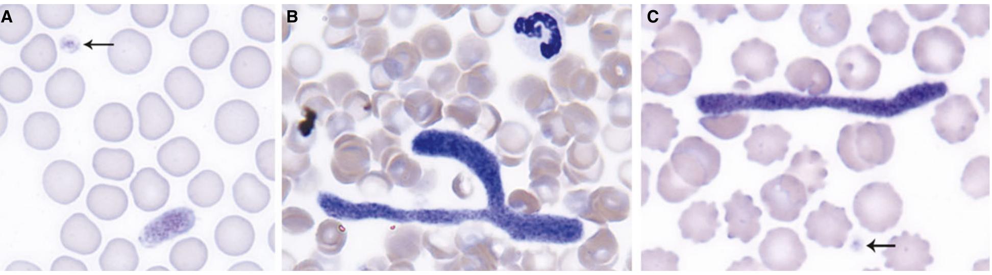 Figure 1 - from A novel form of macrothrombocytopenia in