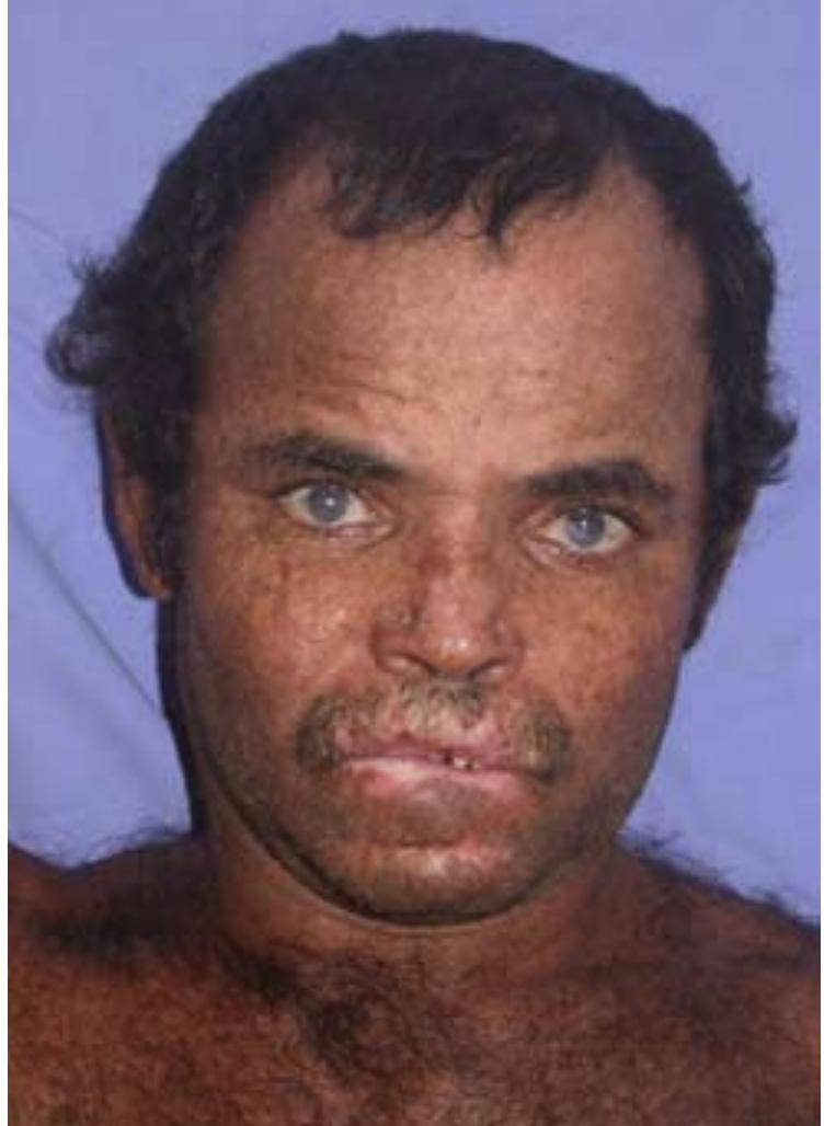 Hyperpigmented macules and papules in the skin face,