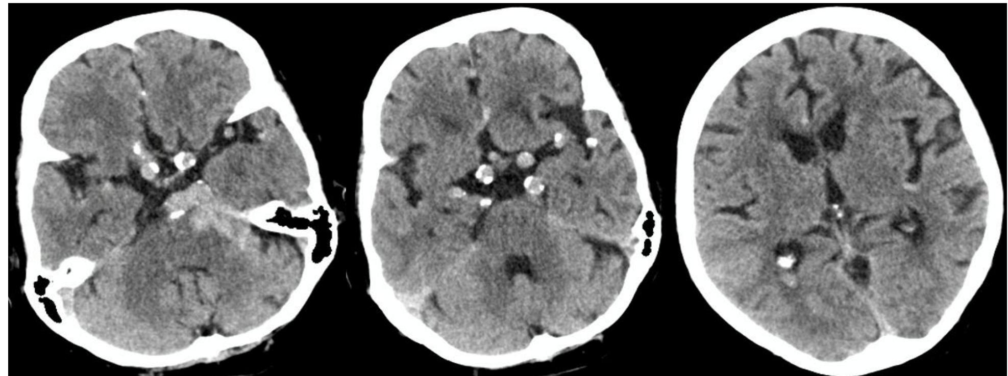 A: cerebral tomography shows subarachnoid hemorrhage signs