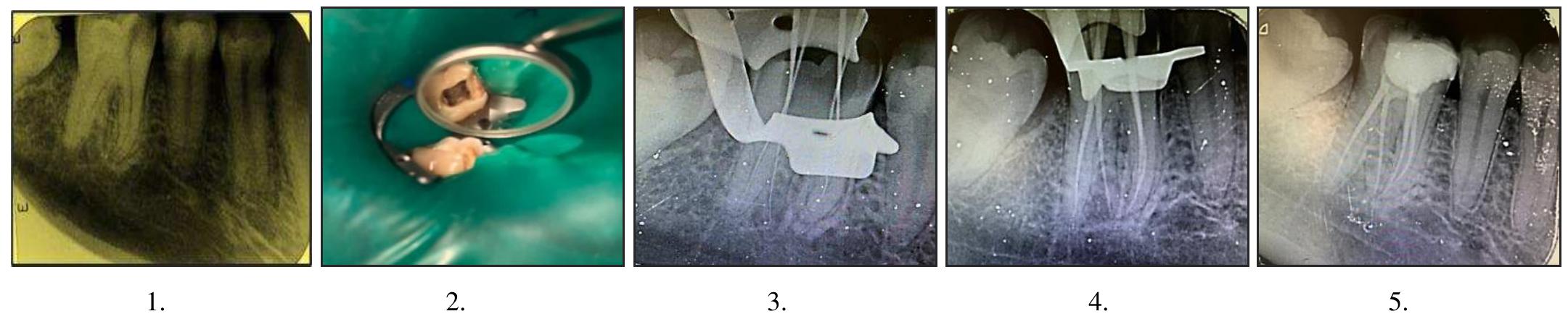 1. preoperative radiograph of tooth 46 2. access opening 3.