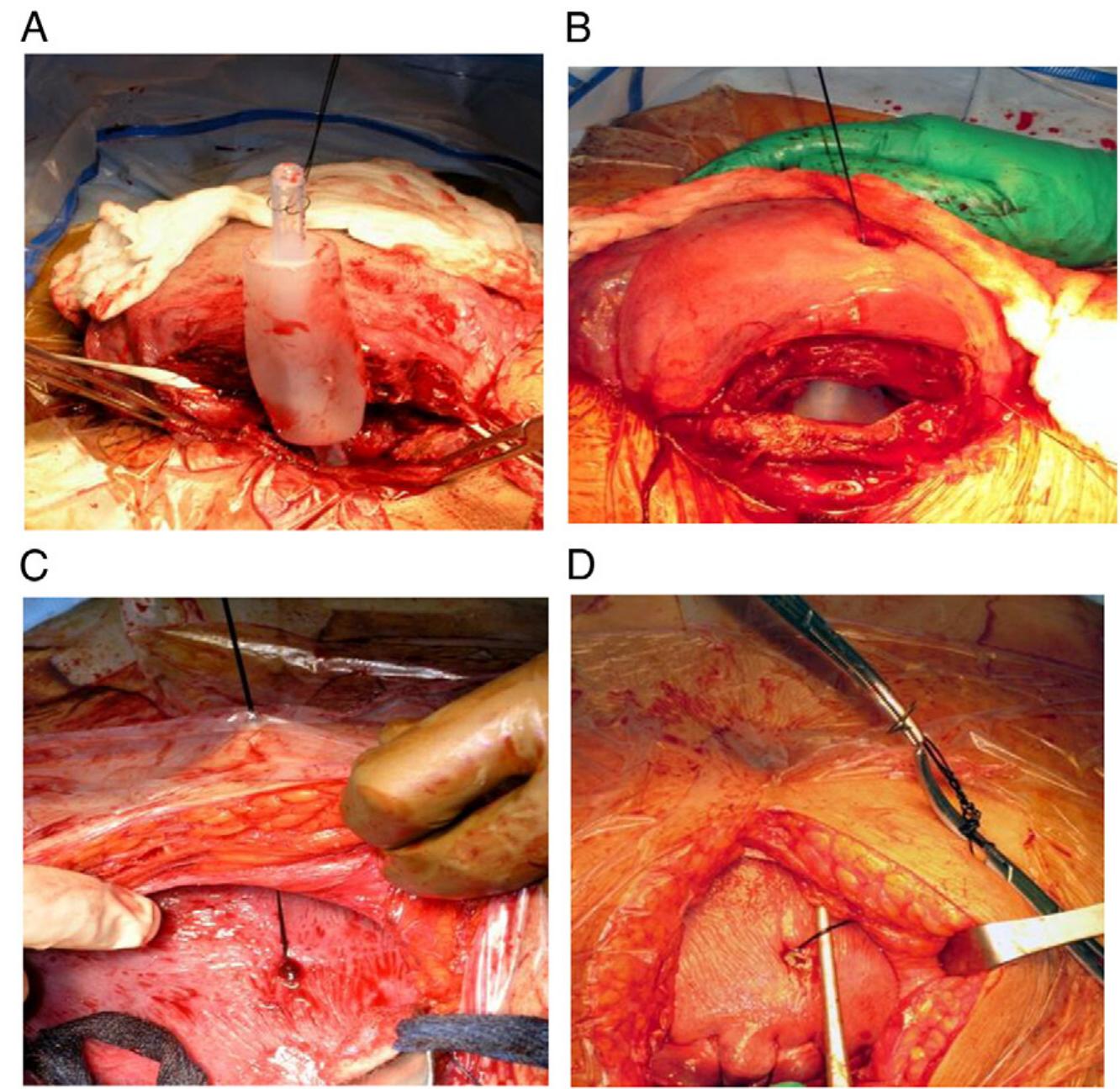 Bakri balloon fixed with a stitch to the skin of the