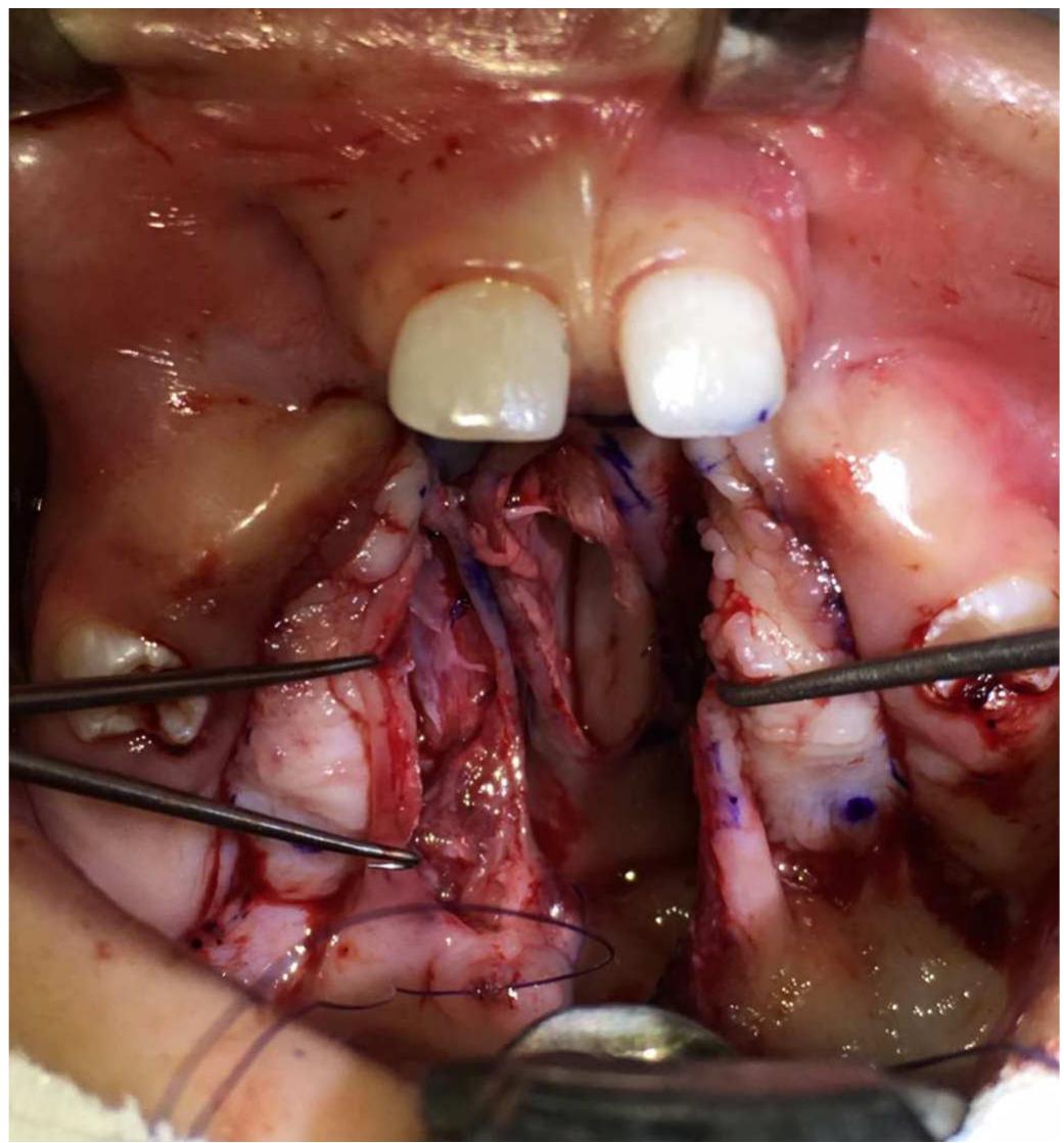 Visualization of the pedicle of the greater palatal artery