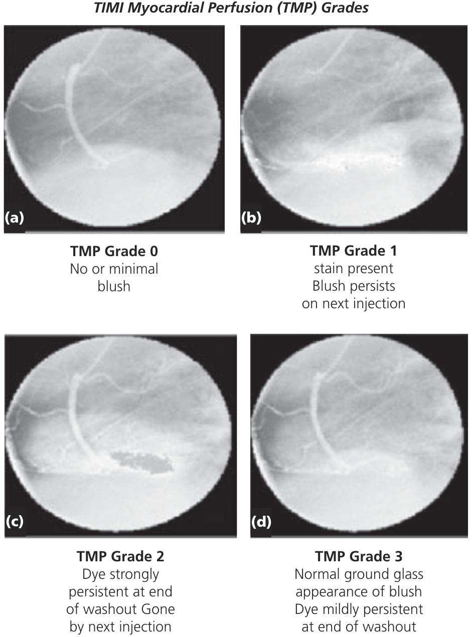 4 the myocardial perfusion grading system: (a) tmp grade 0: