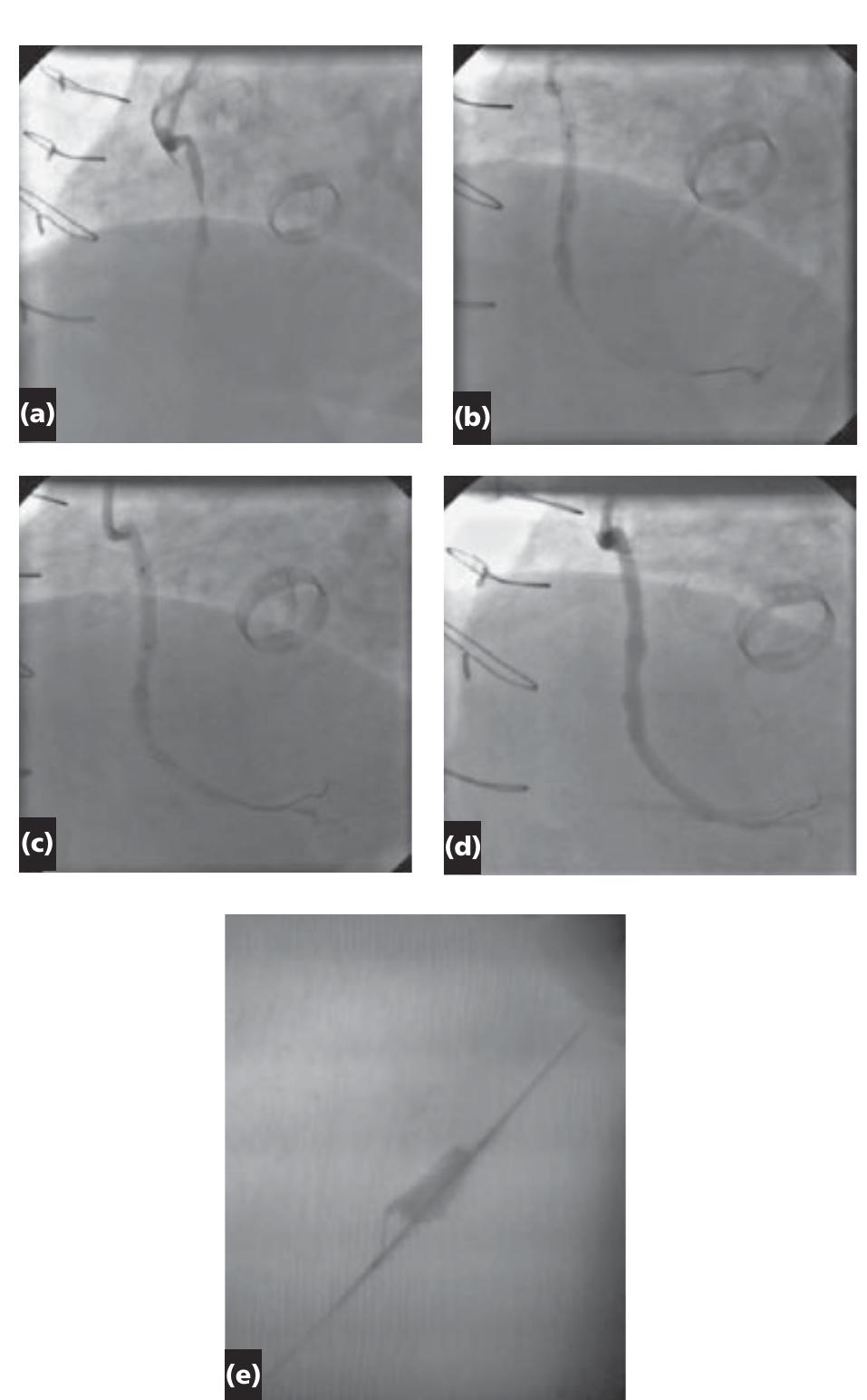 6 acute occlusion of saphenous vein graft to distal rca with