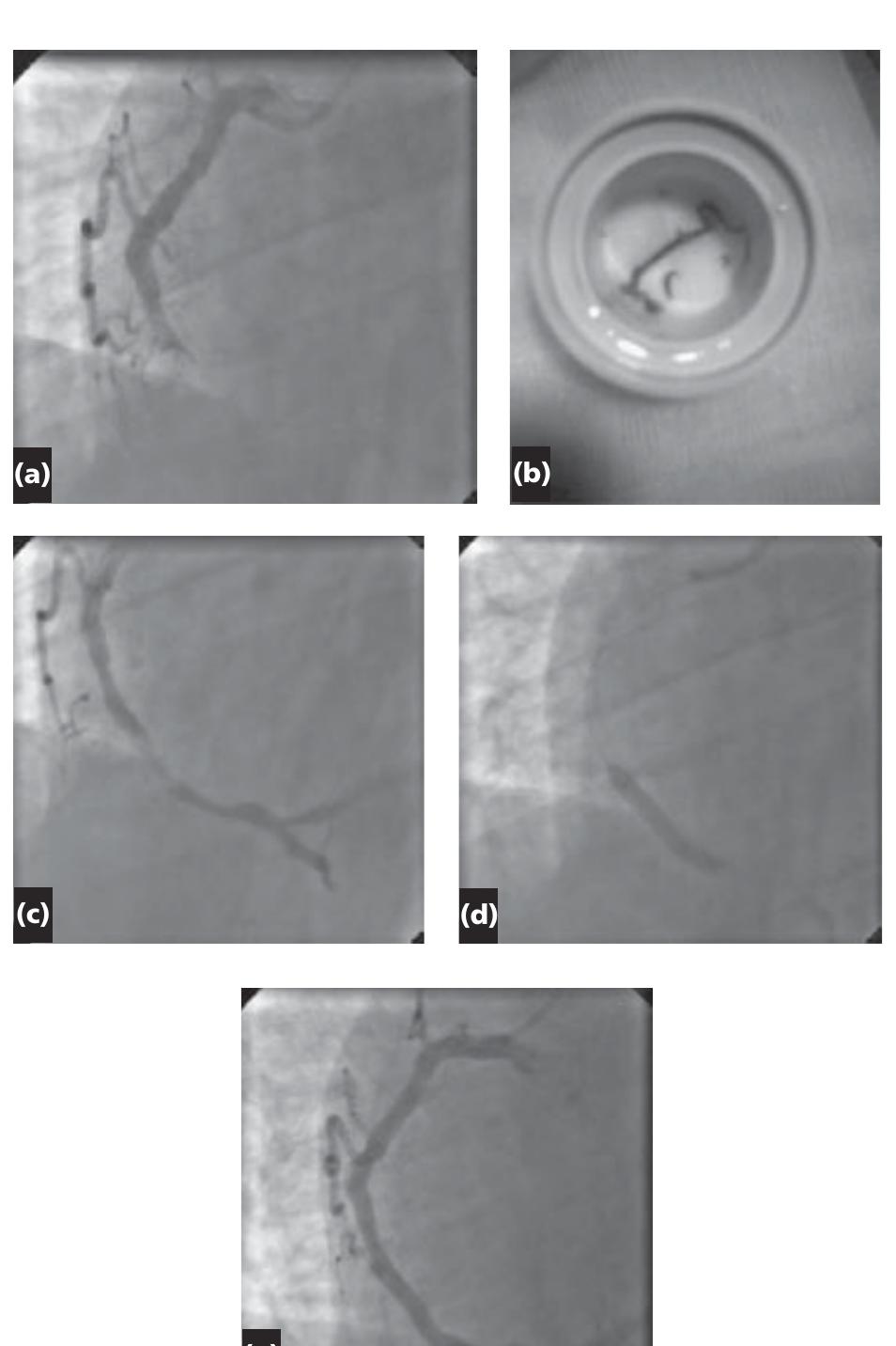 7 catheter aspiration of thrombus in a patient with evolving