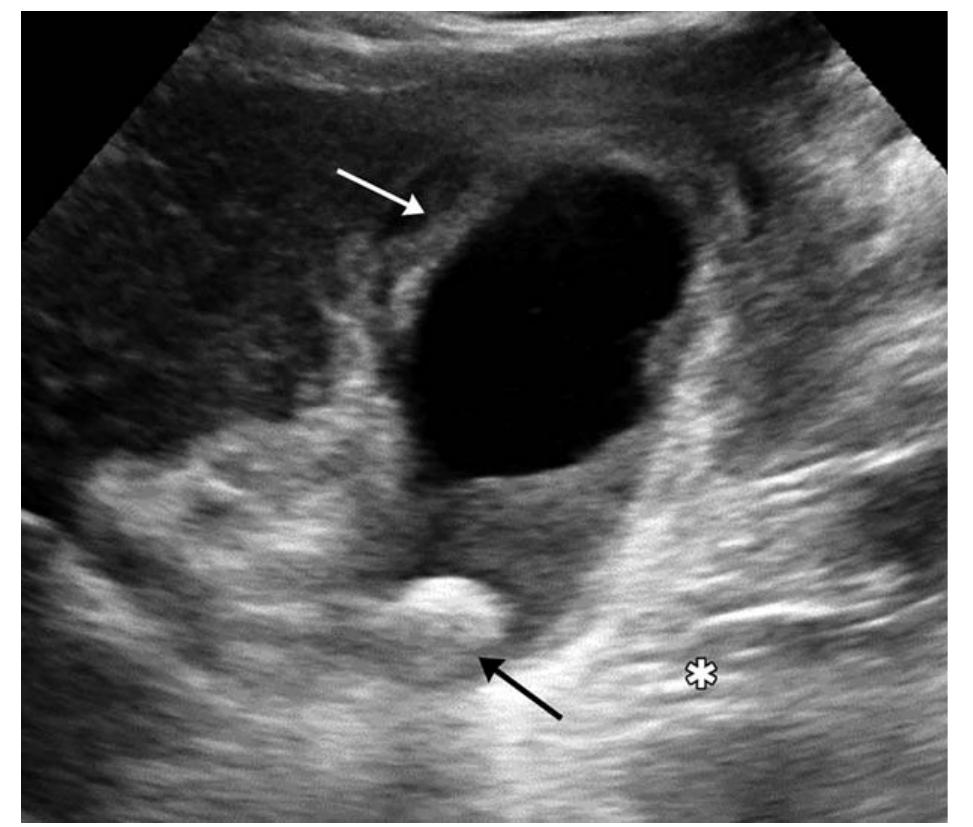 Acute cholecystitis in a 72-year-old male. gray scale image