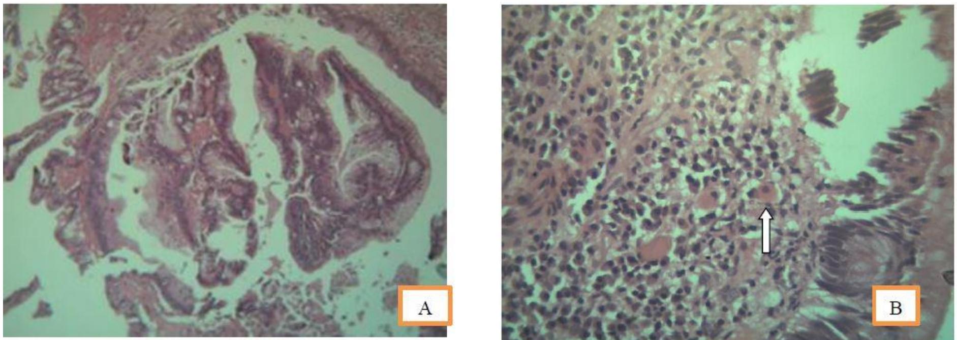 A: histomorphology of endoscopic biopsy showing adenomatous