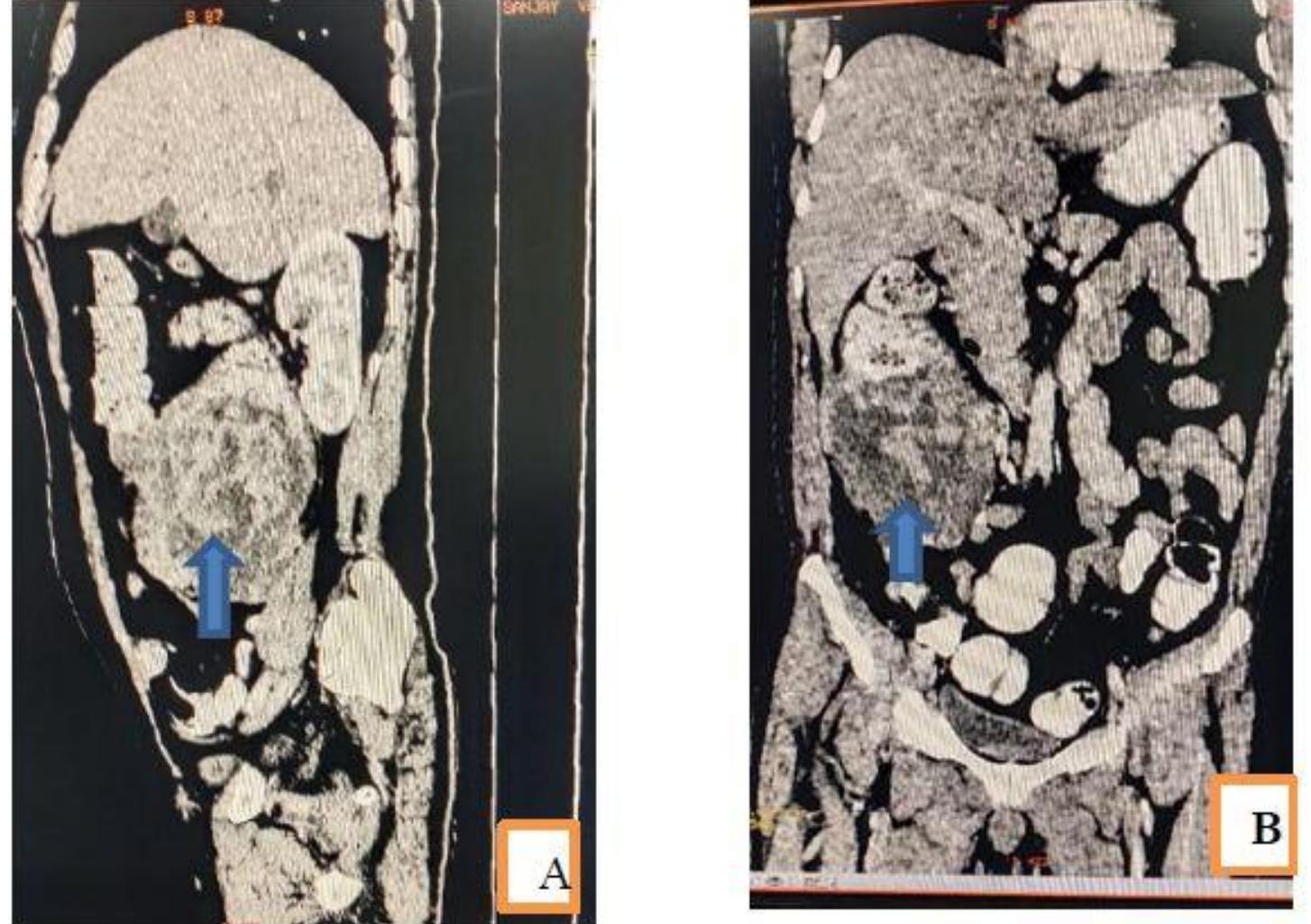 A and b: saggital and coronal sections of ct scan from