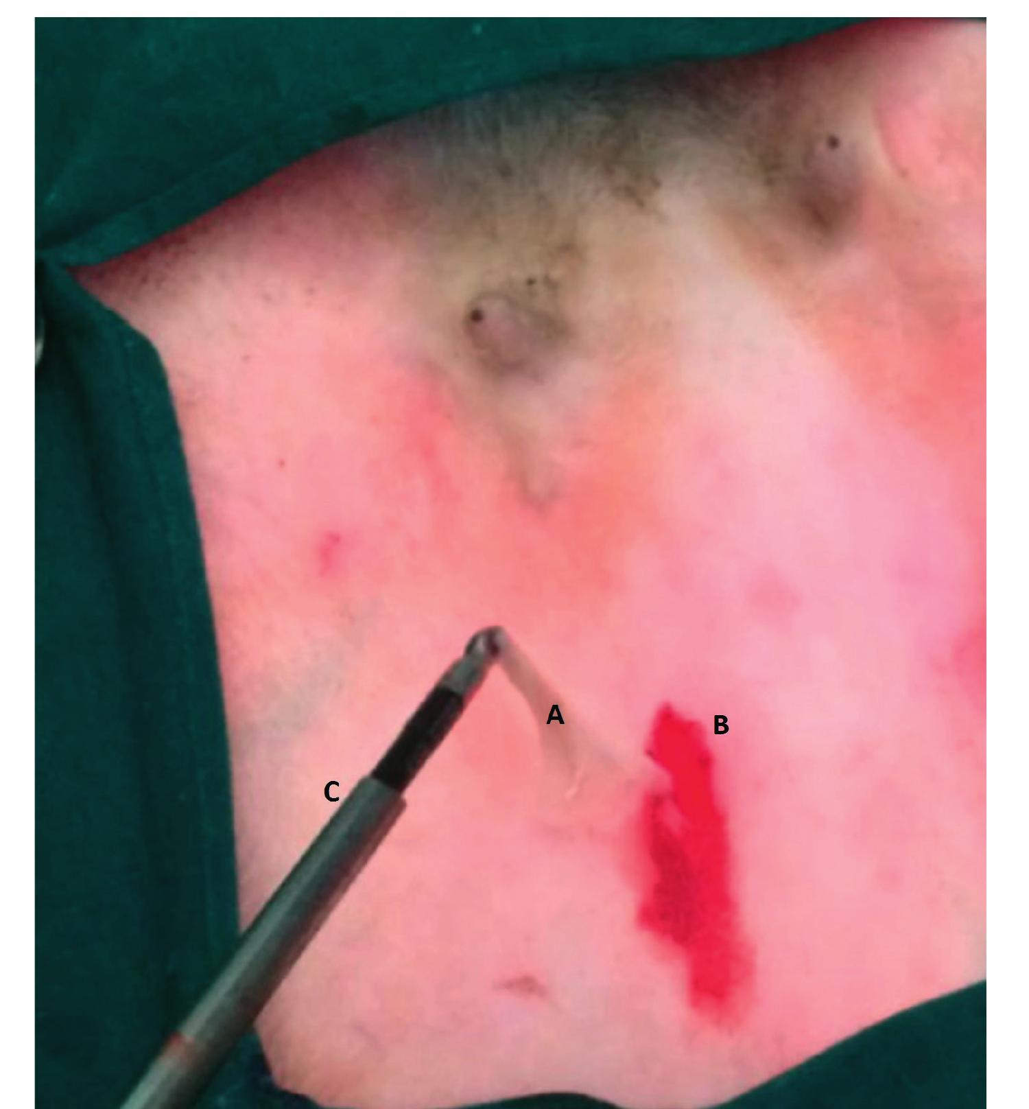 Retrieved evacuated cyst wall: a) empty cyst after retrieval