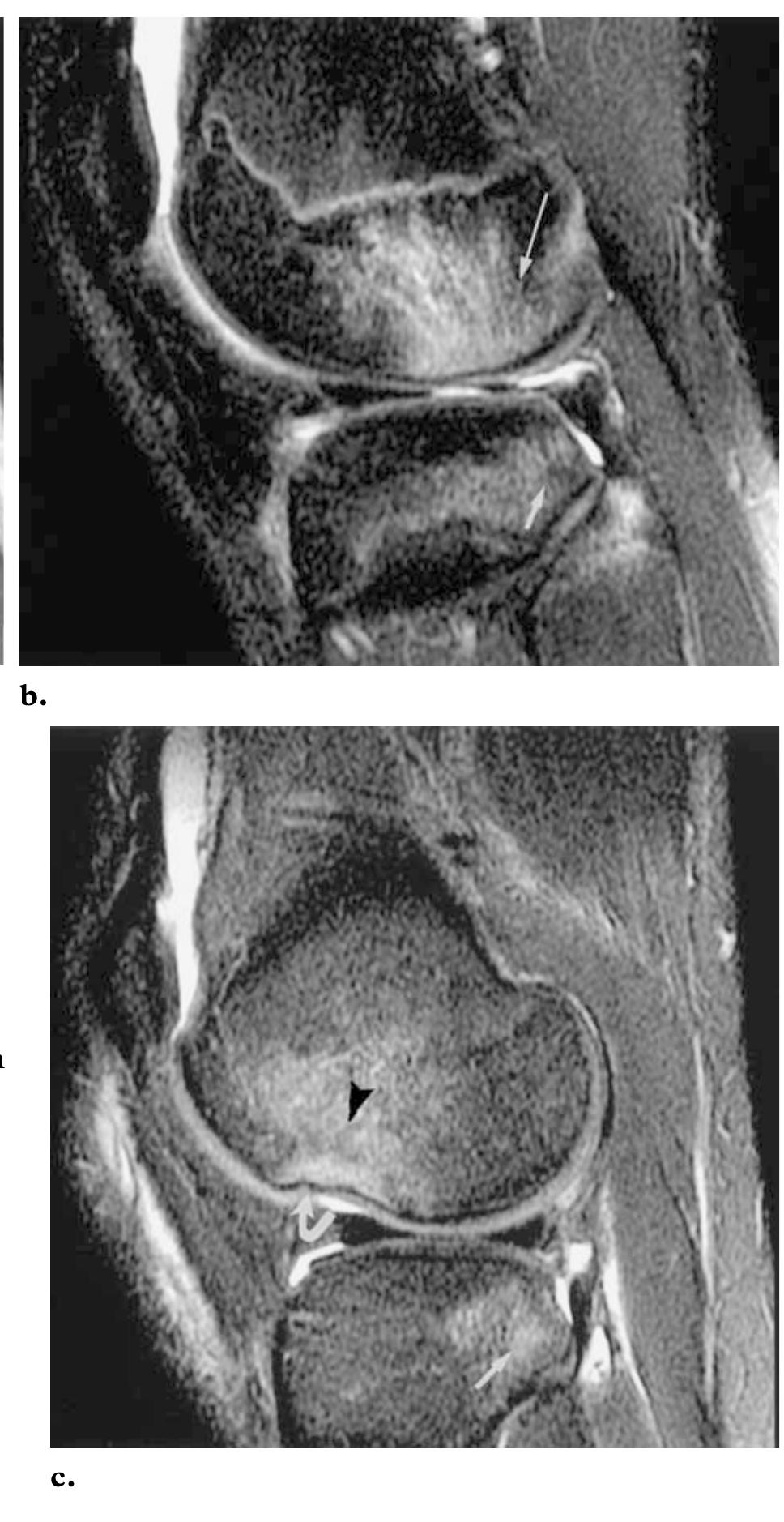 (PDF) Bone Contusion Patterns of the Knee at MR Imaging: Footprint of ...