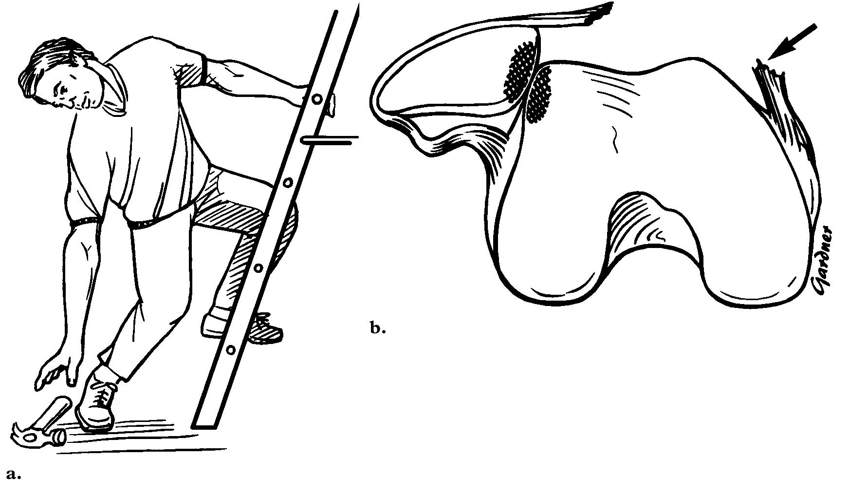 Lateral patellar dislocation. (a) drawing shows the classic