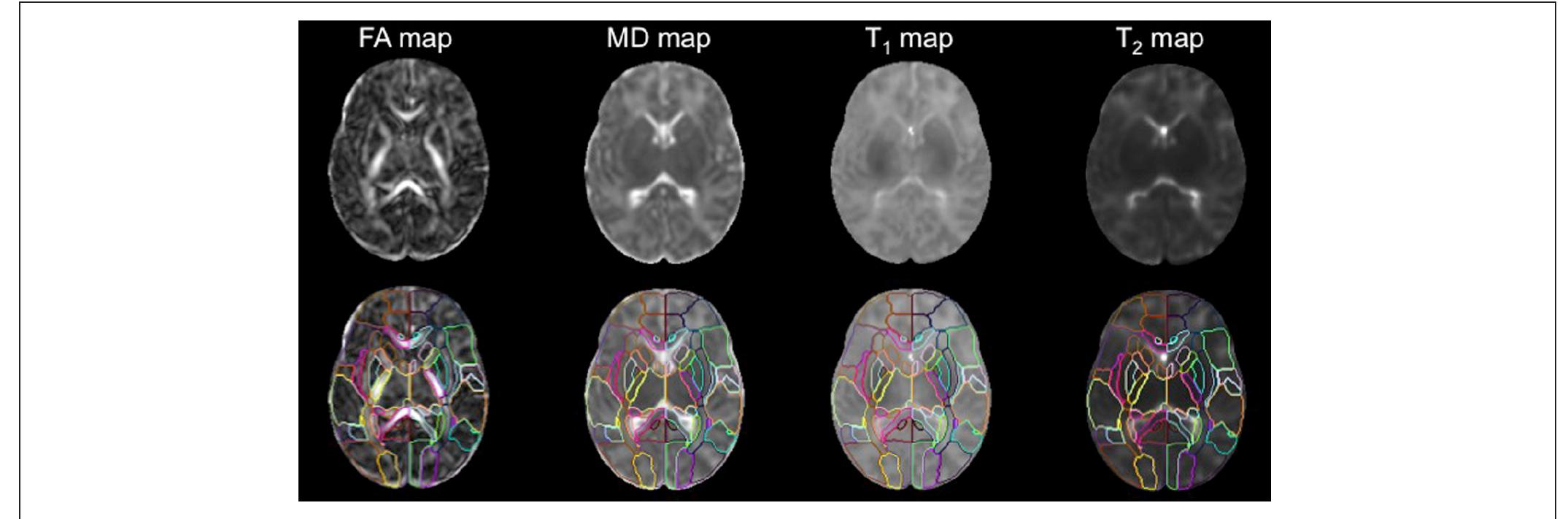 | the dti, t1, and t2 maps were transformed from the subject