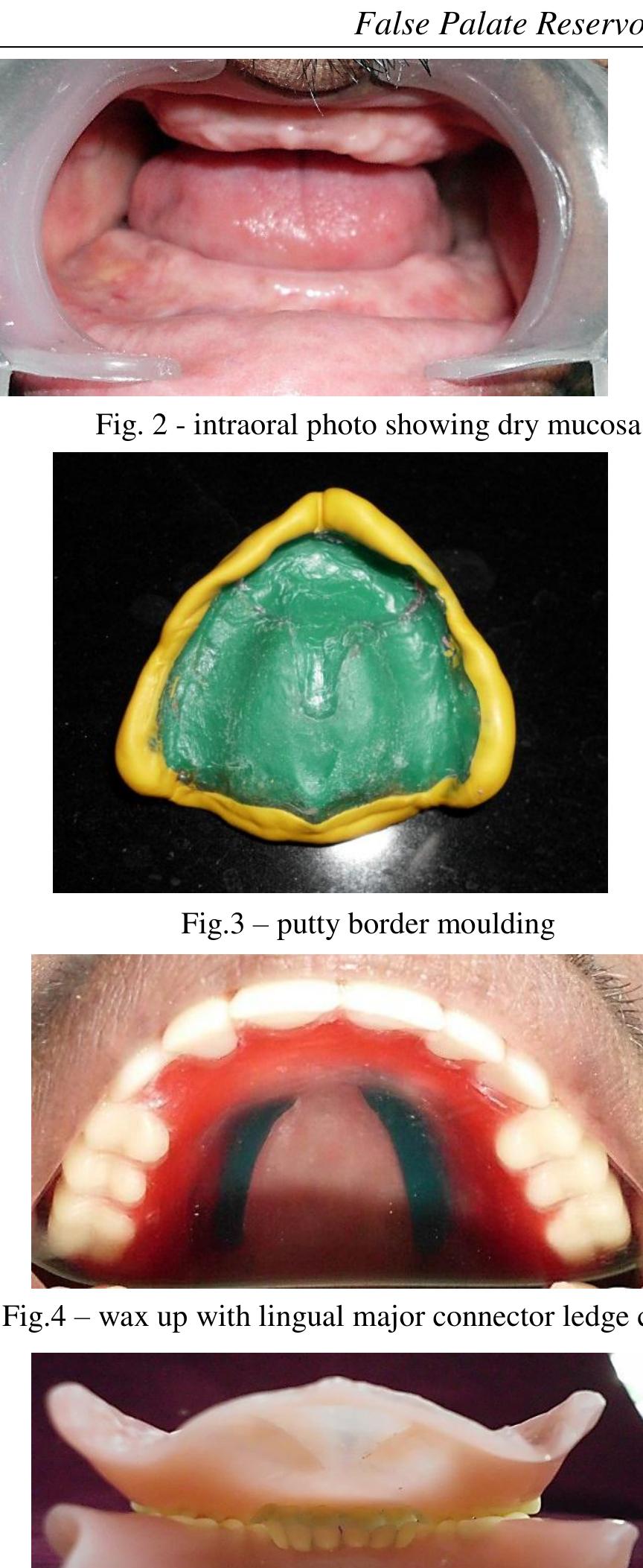 acrylised dentures with ledge visible in maxillary denture