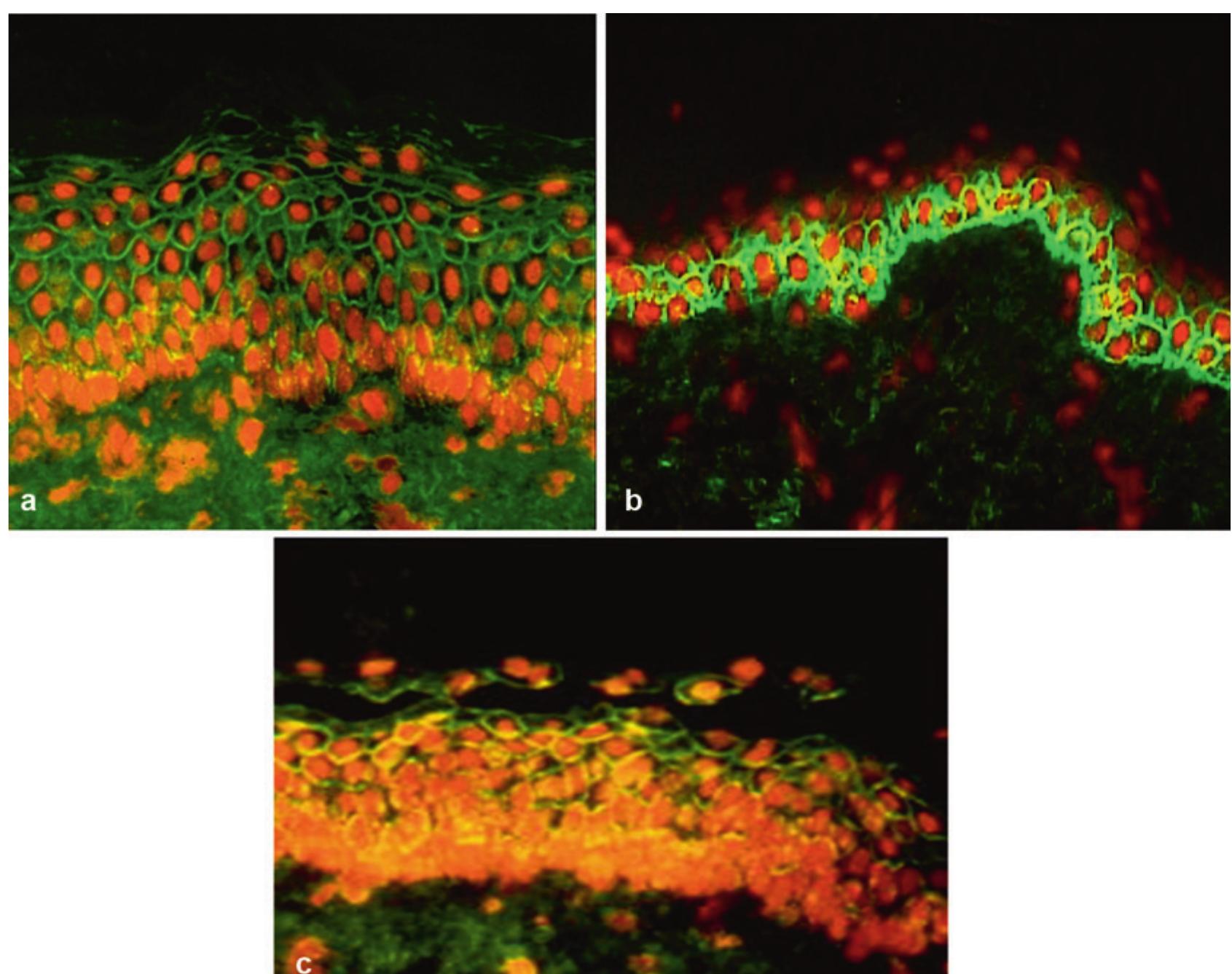 Direct immunofluorescence of an oral biopsy show- ing