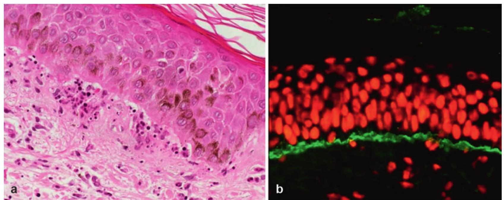 Hematoxylin and eosin stained section showing incipient