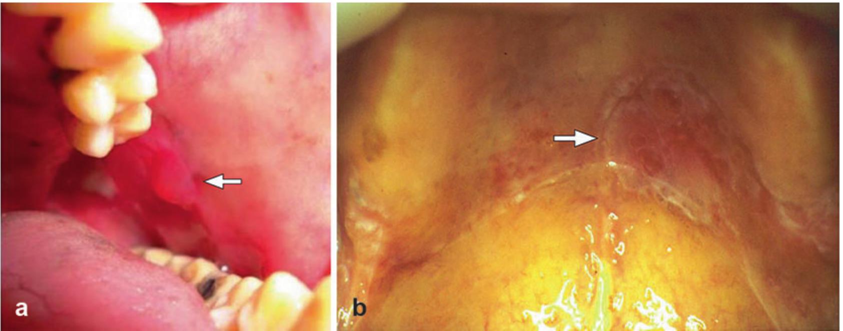 Bullous oral lichen planus showing intact bullous on the