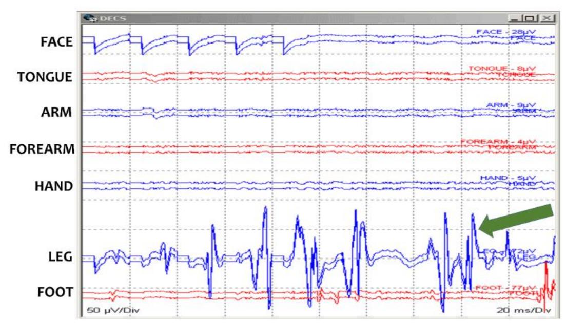 Motor mapping responses after bipolar handheld stimulation