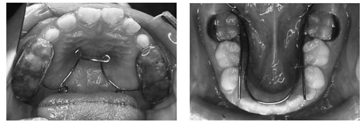 Intraoral occlusal view of constriction quad-helix appliance