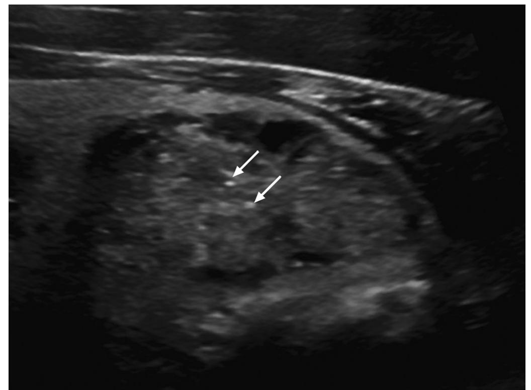 Ultrasound image of a benign nodule (nodular hyperplasia)