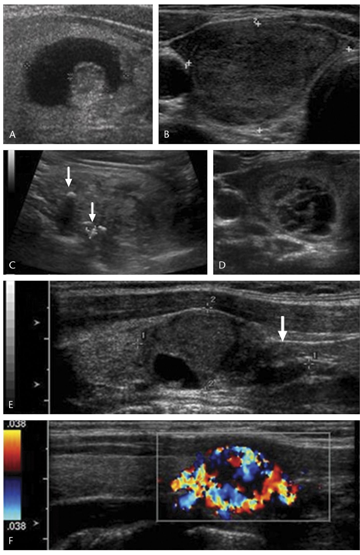 Range of appearances of nodular hyperplasia. cystic with
