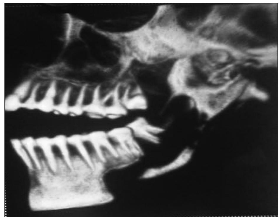 Surgical exposure figure 1: multilocular aneurismal bone