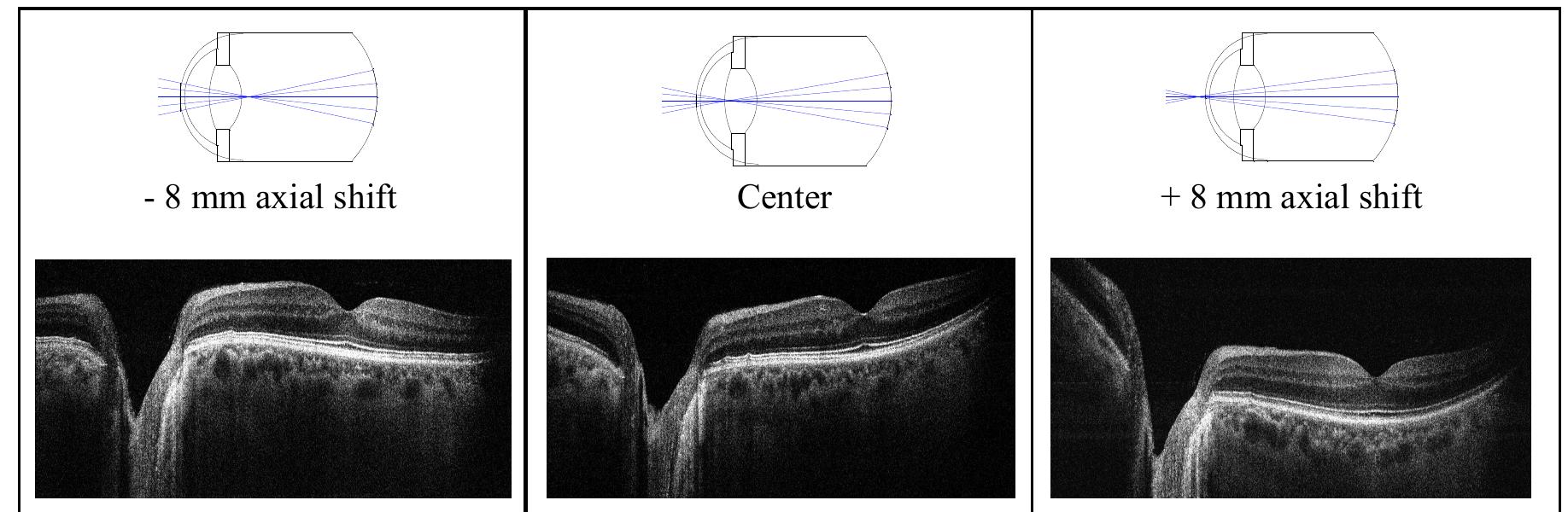 Visualization of the retinal distortions caused by axial