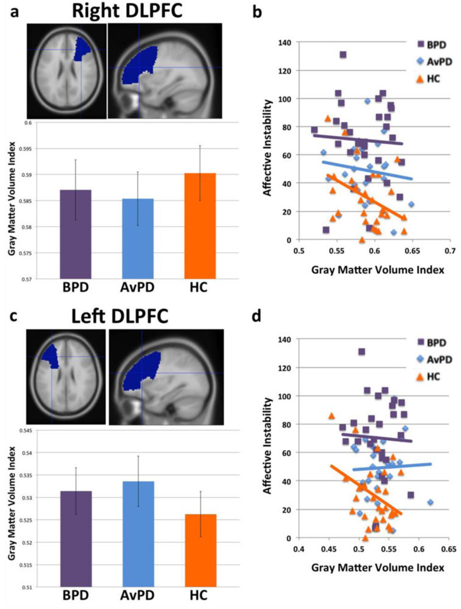 Figure 4 - Brain structural anomalies in borderline and