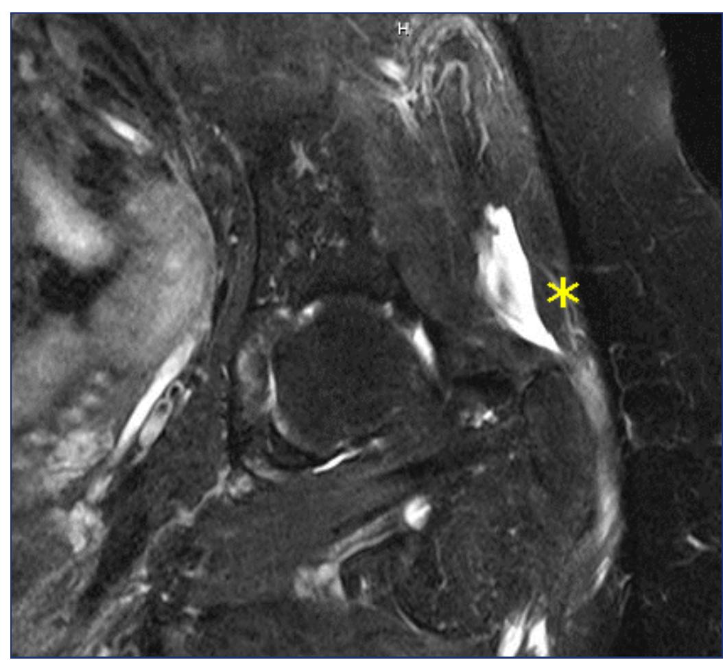 A t2 fat-saturated coronal mri cut of the patient's left hip