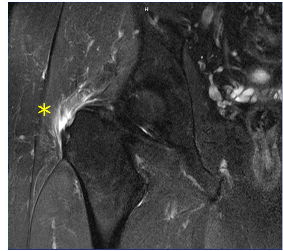 A t2 fat-saturated coronal mri cut of the patient's right
